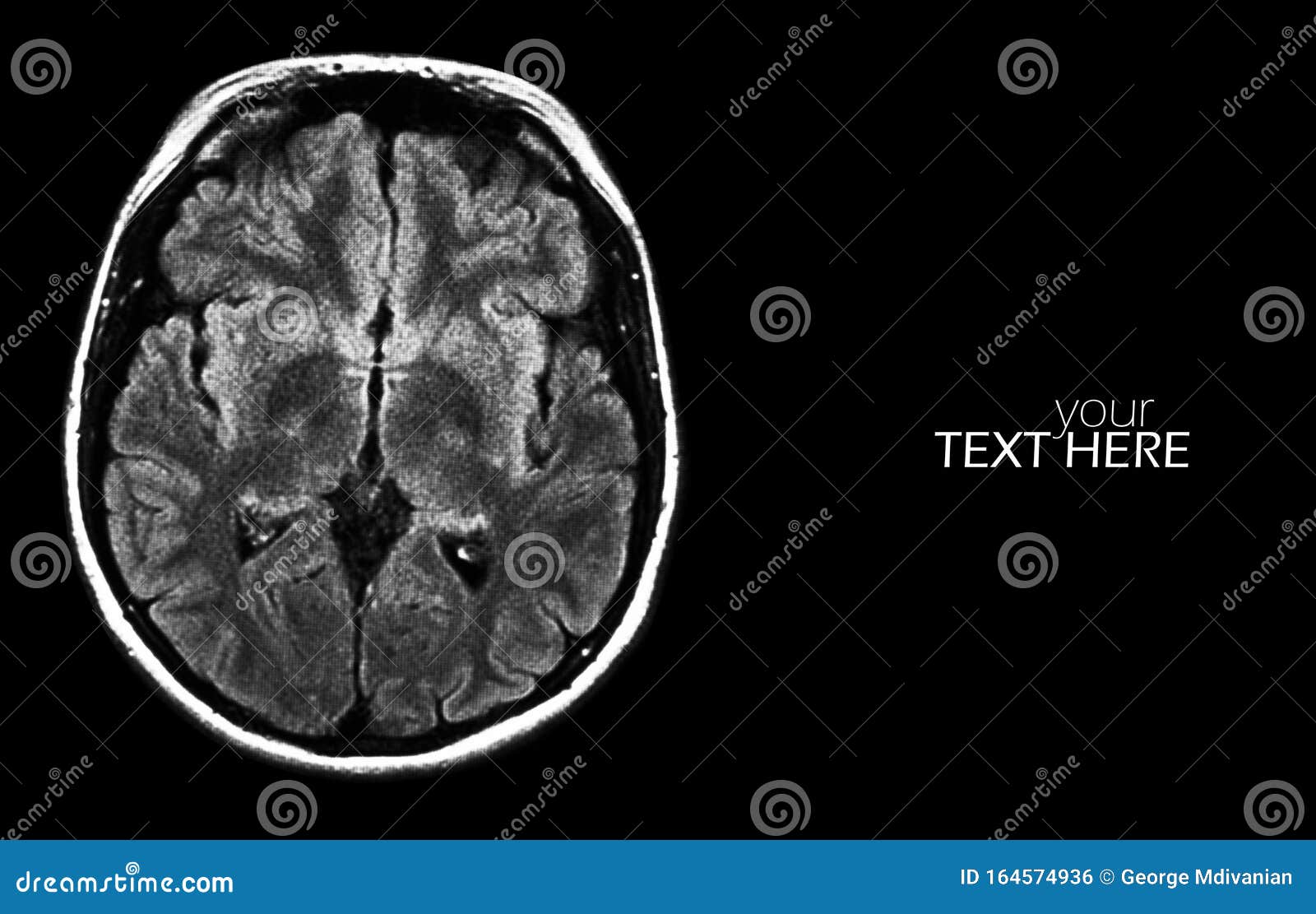 Brain MRI scan stock photo. Image of black, resonance - 164574936