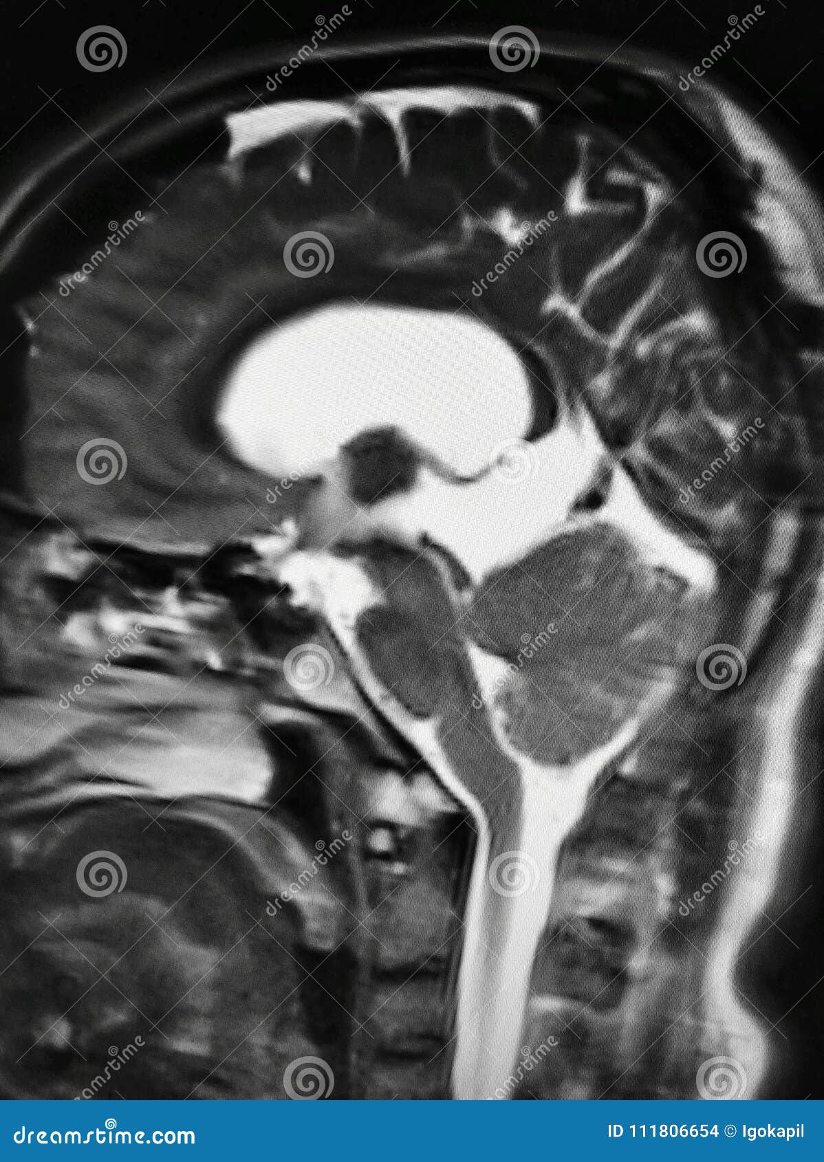 Brain Pathology Pineal Cyst Mri Exam Stock Illustration - Illustration ...