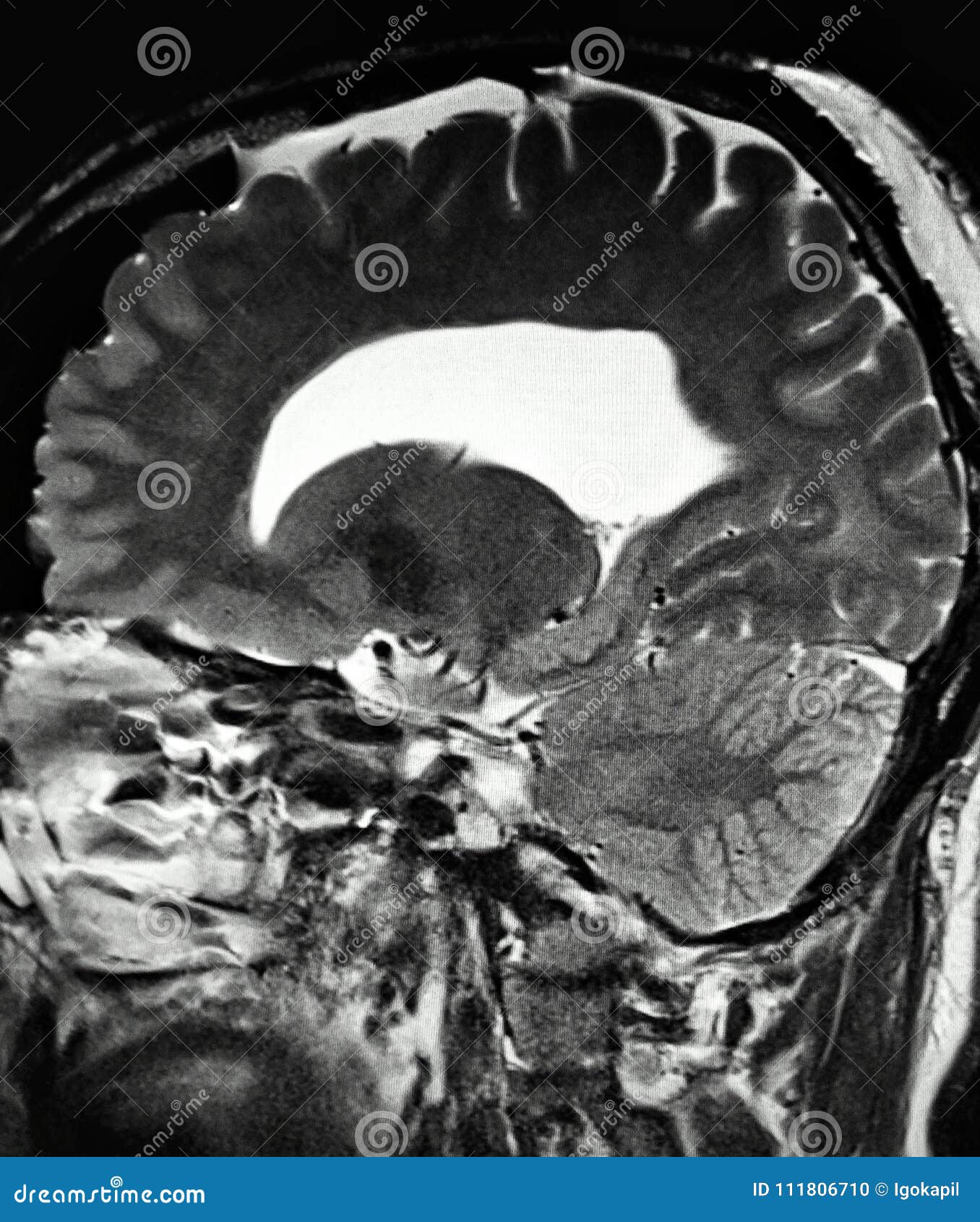 Brain Pathology Pineal Cyst Mri Exam Stock Illustration - Illustration ...