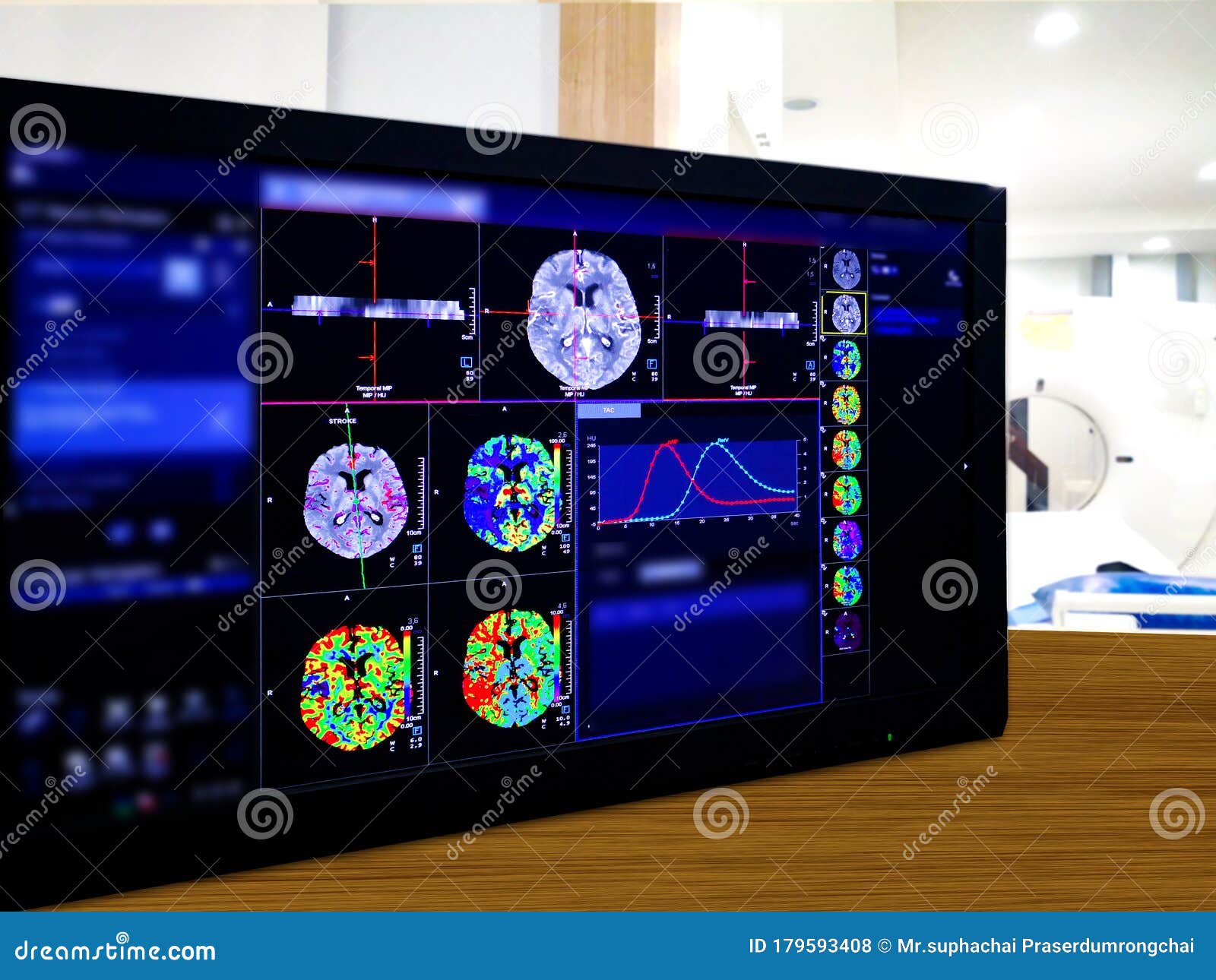 Brain Perfusion Or CT Scan Of Blood Flow. In The Brain 3d Rendering ...