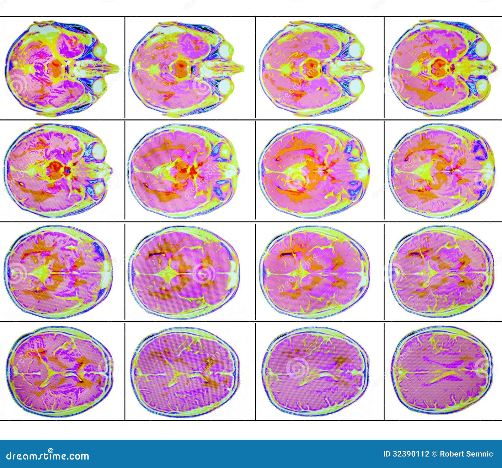 Brain Perfusion MR Imaging Stock Photo | CartoonDealer.com #32390112