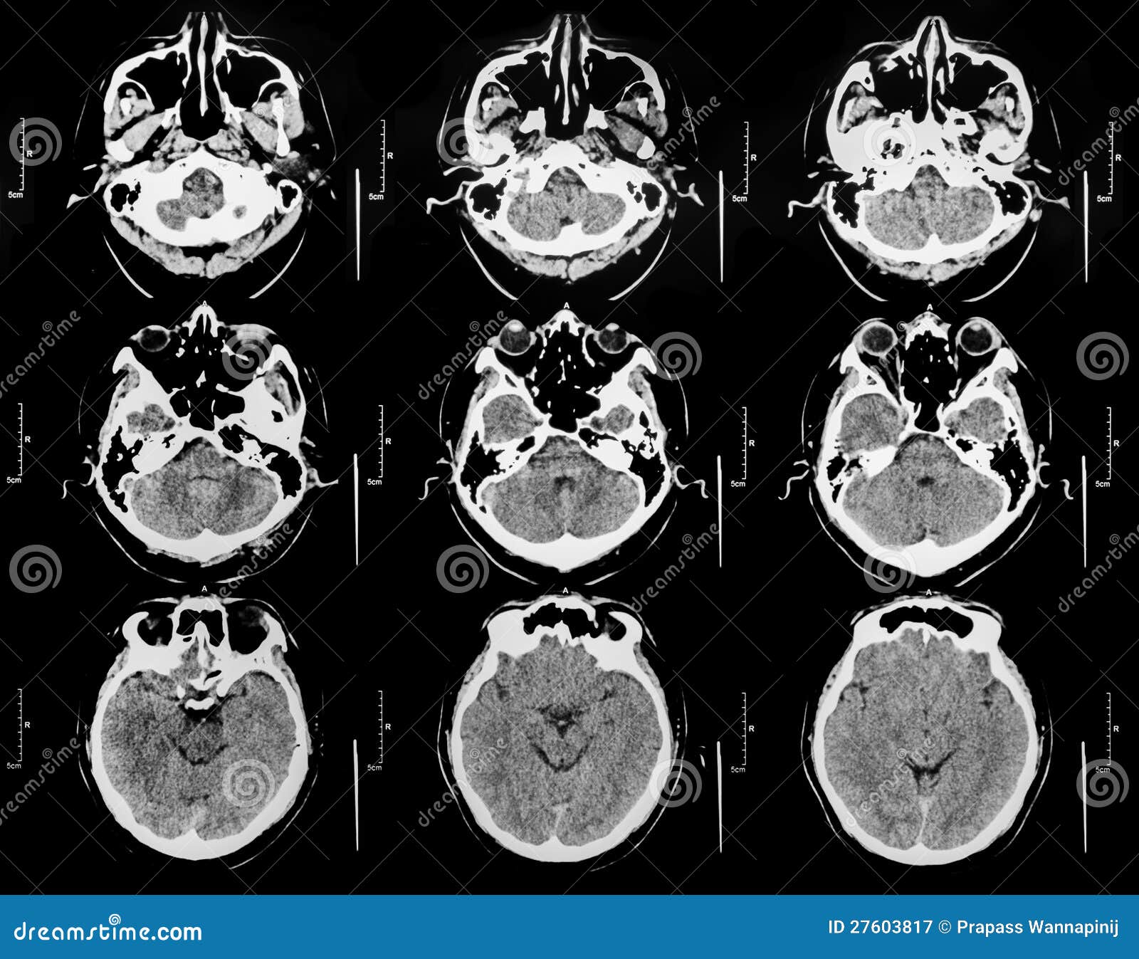 Brain x-ray scan film stock image. Image of head, health - 27603817