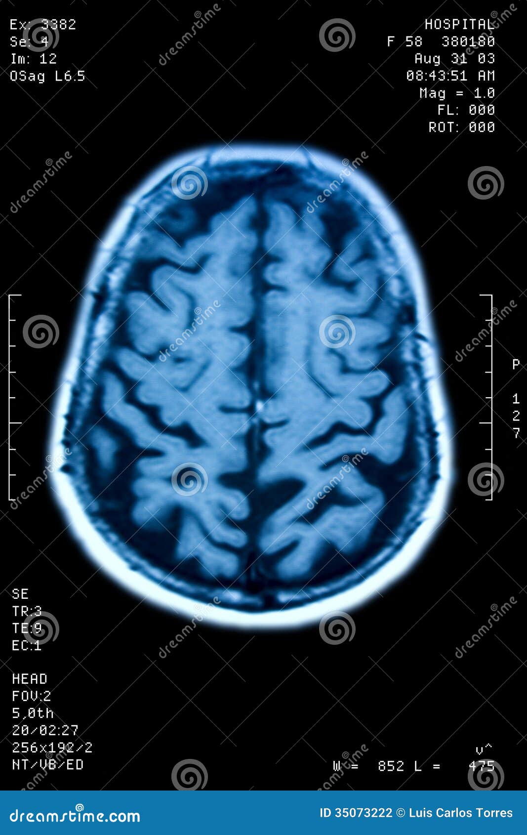 Brain resonance stock photo. Image of disease, healthy - 35073222