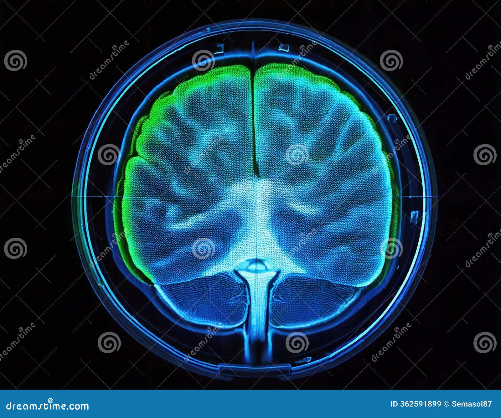 Detailed Brain Tomography Scan Showing Regions of Activity and ...