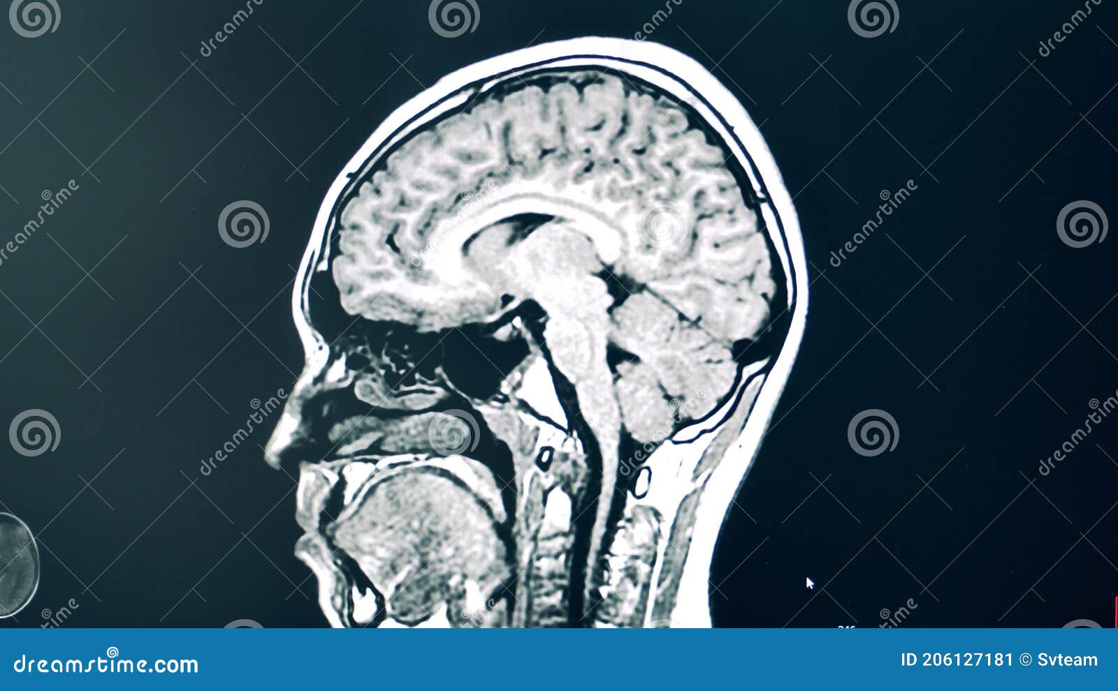 Brain Scanning during an MRI Procedure Stock Video - Video of ...