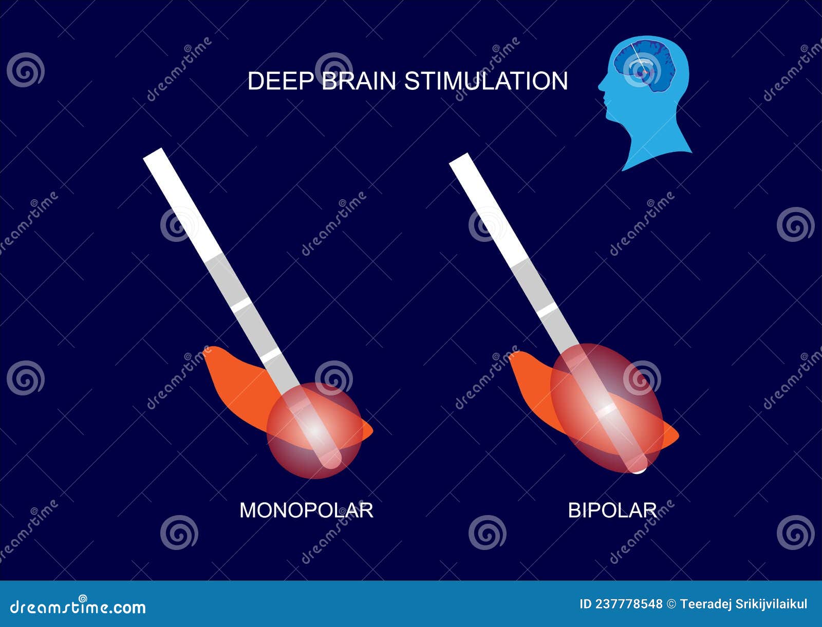 Deep Brain Stimulation For Treatment Of Parkinson Disease Vector ...