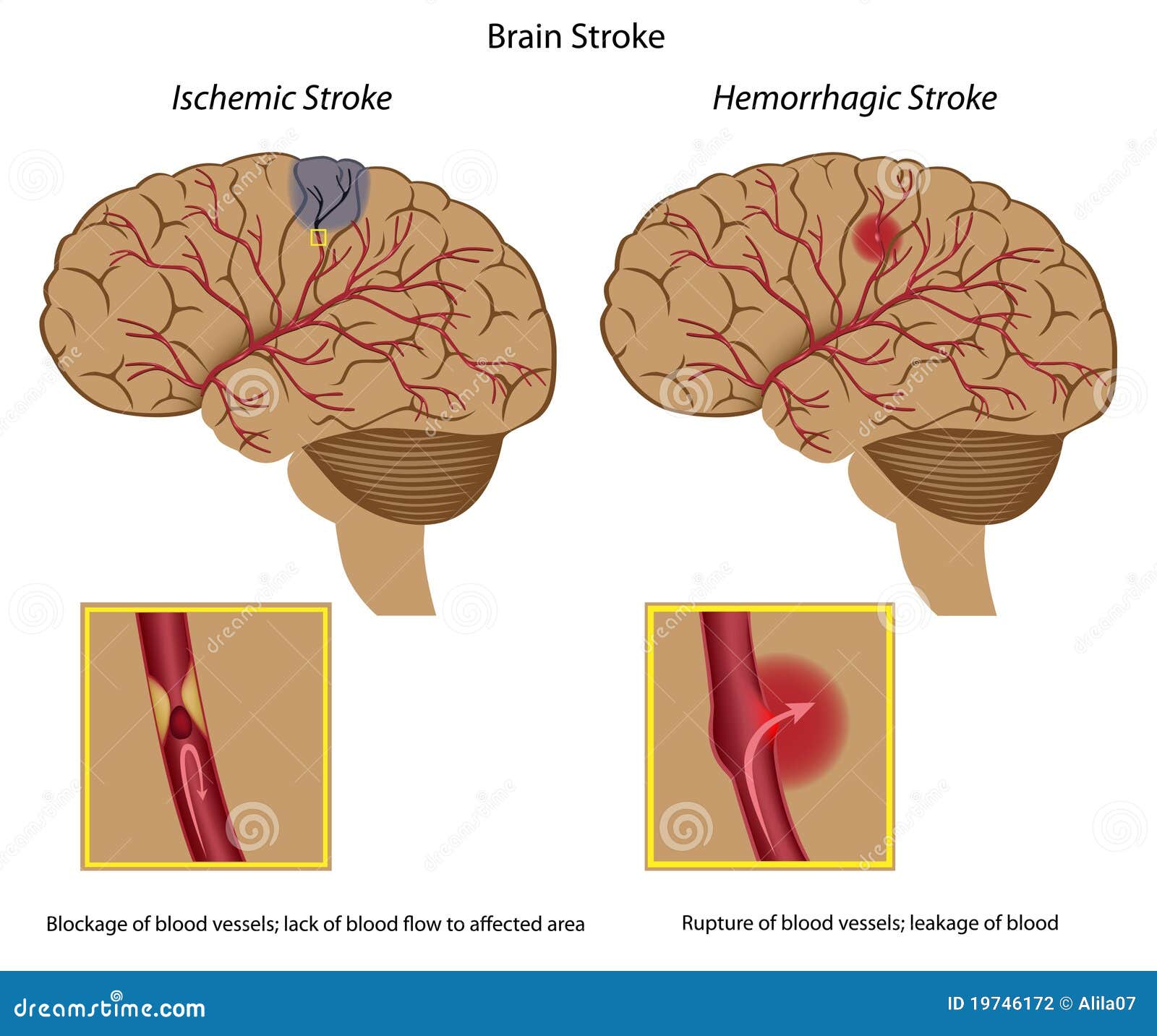 Brain stroke stock vector. Illustration of blocked, ischemic - 19746172