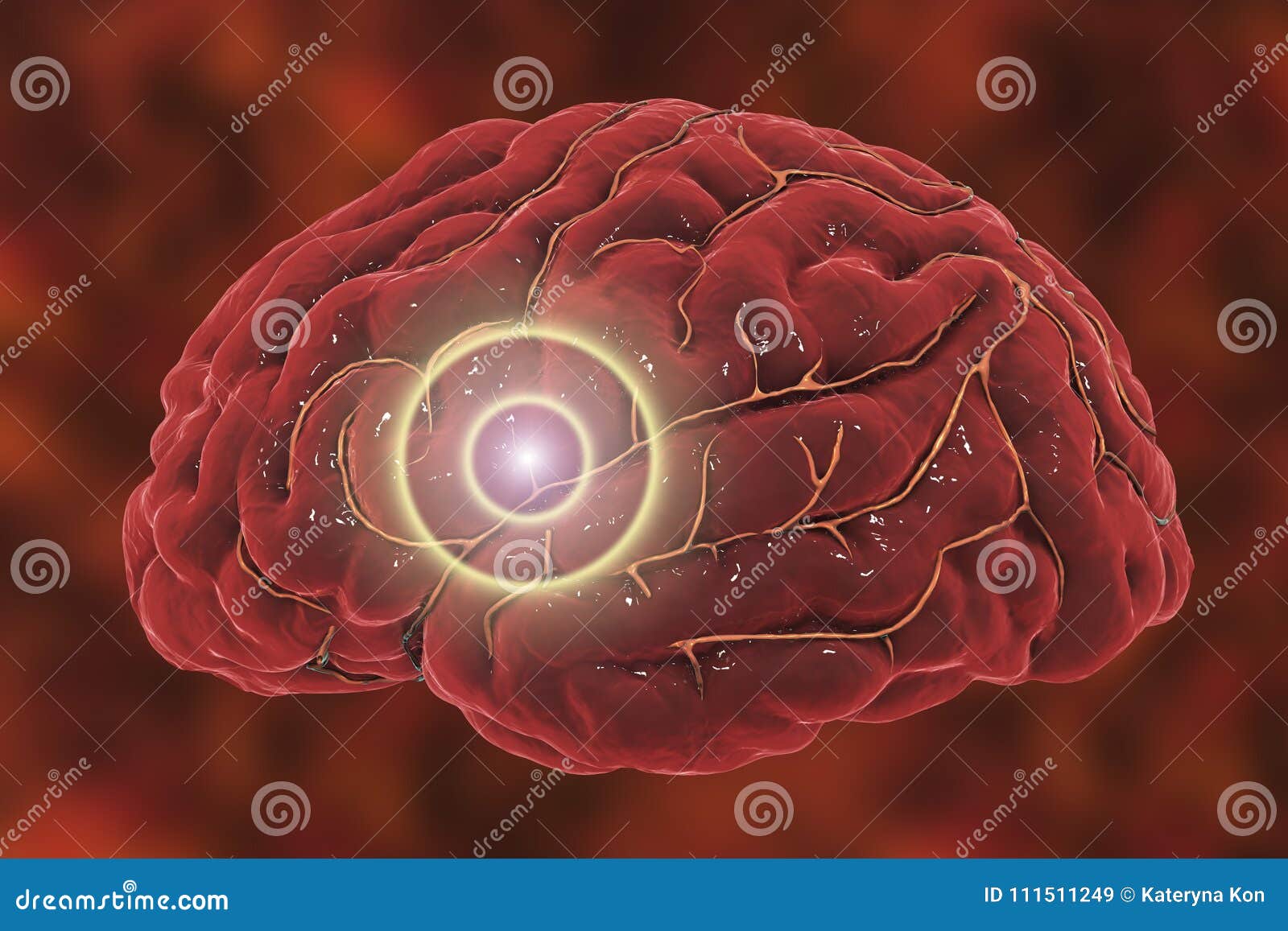 Mri Brain Stroke Royalty-Free Stock Image | CartoonDealer.com #52527988