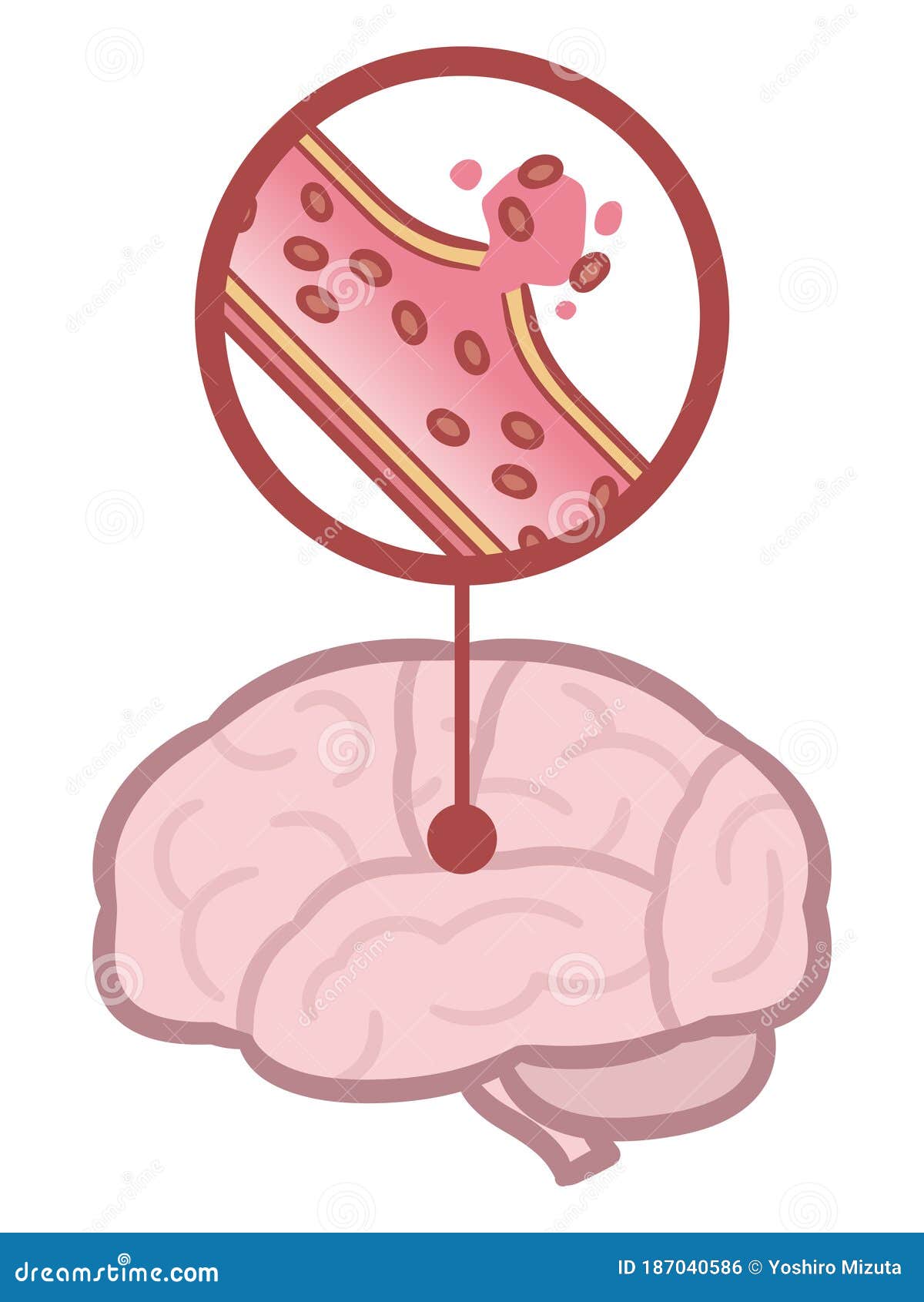 Cerebral Hemorrhage Cartoon Vector | CartoonDealer.com #44474853