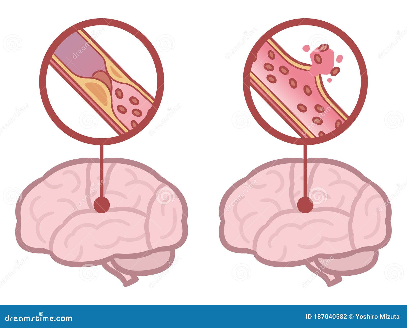 Ischemic And Hemorrhagic Stroke Cartoon Vector | CartoonDealer.com ...