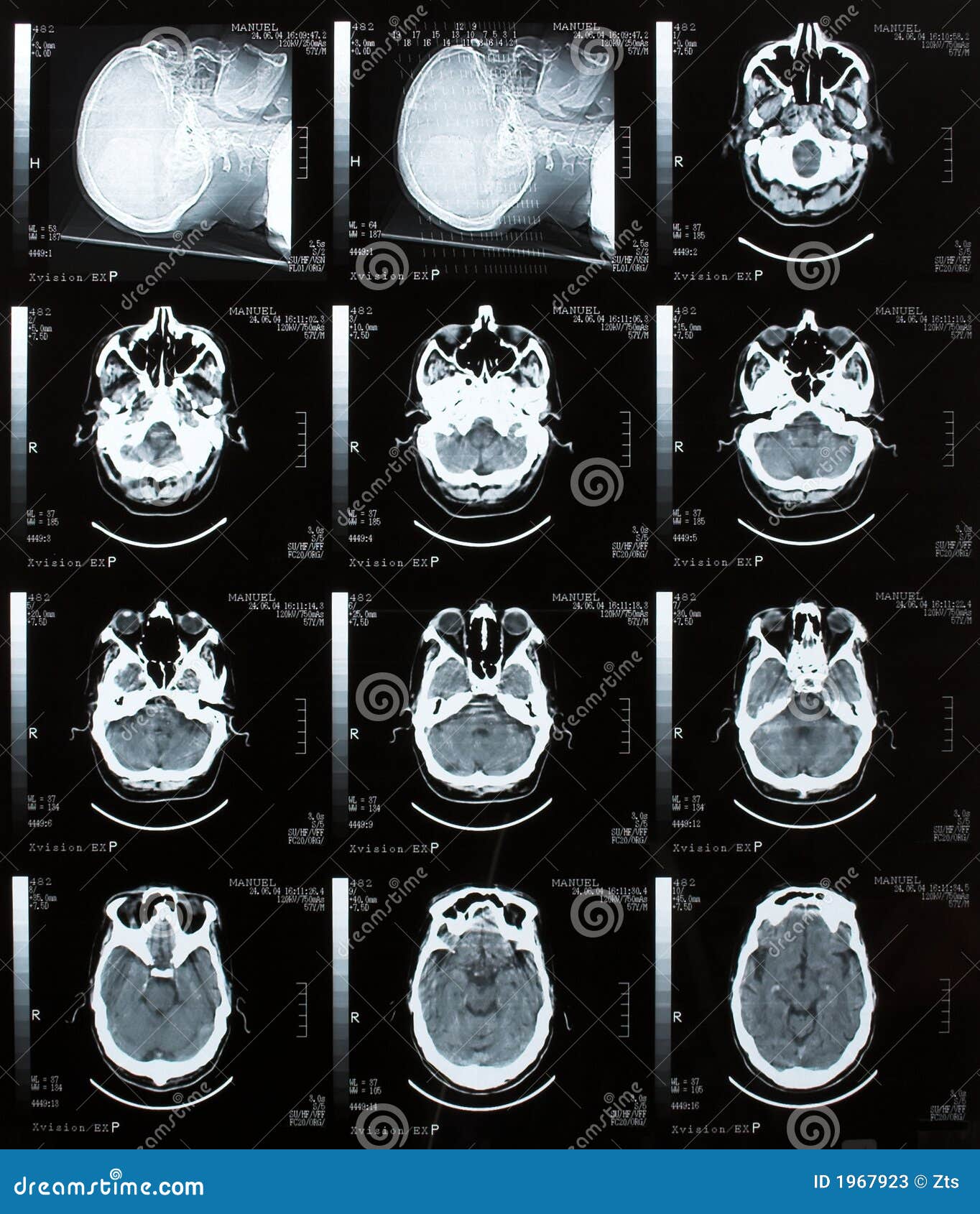 Brain Tomography stock image. Image of aided, skeleton - 1967923