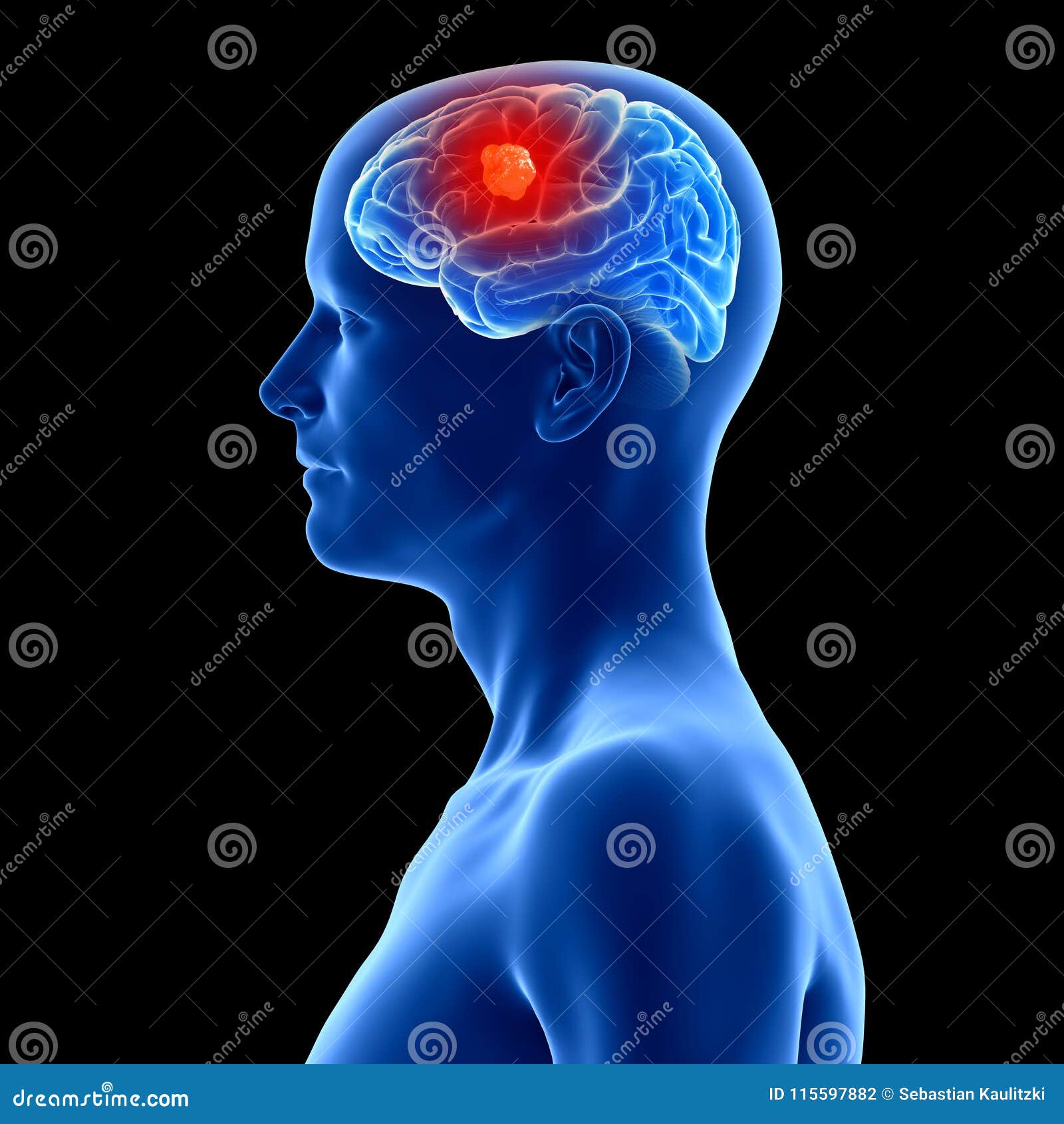 A brain tumor stock illustration. Illustration of graphic - 115597882