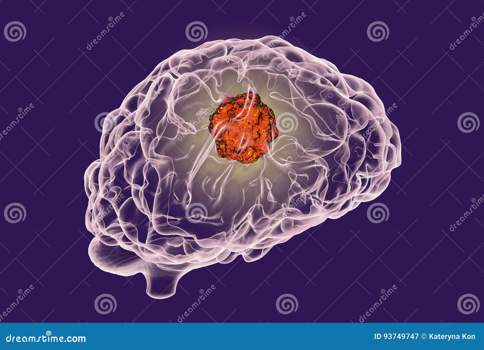 Brain tumor, illustration stock illustration. Illustration of isolated ...