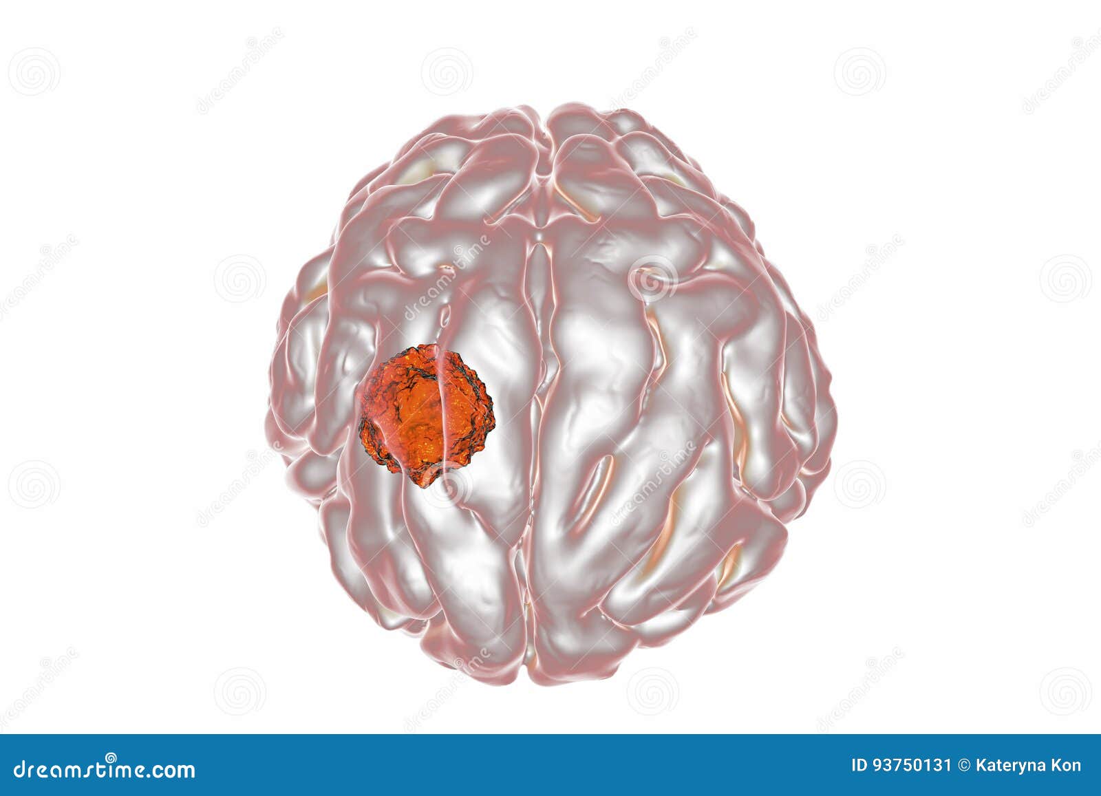 Brain tumor, illustration stock illustration. Illustration of brain ...