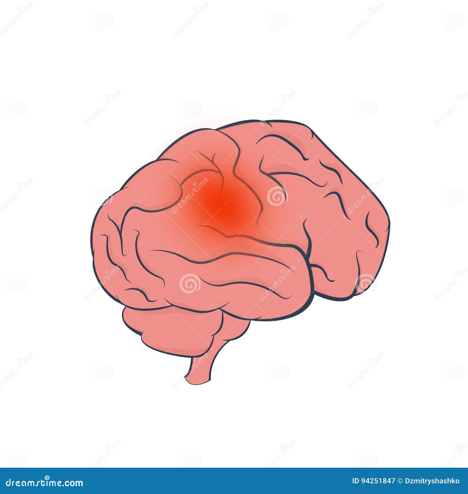 Brain tumor vector design stock vector. Illustration of abdominal ...