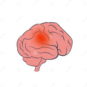 Brain tumor vector design stock vector. Illustration of abdominal ...