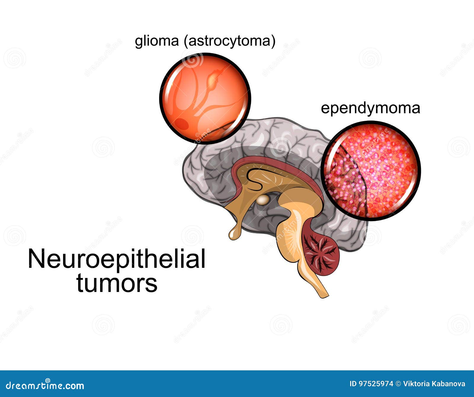 Brain Tumour 2, Neurosurgery Stock Vector - Illustration of cancer ...