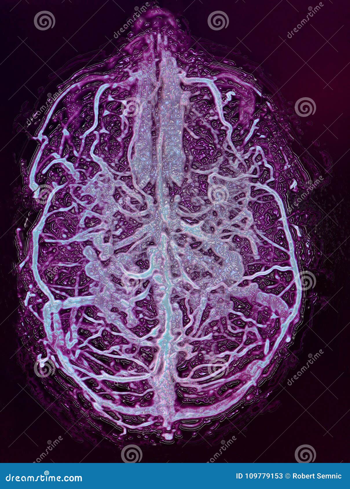 Brain Veins Illustration, MRI Stock Image - Image of abnormalities ...