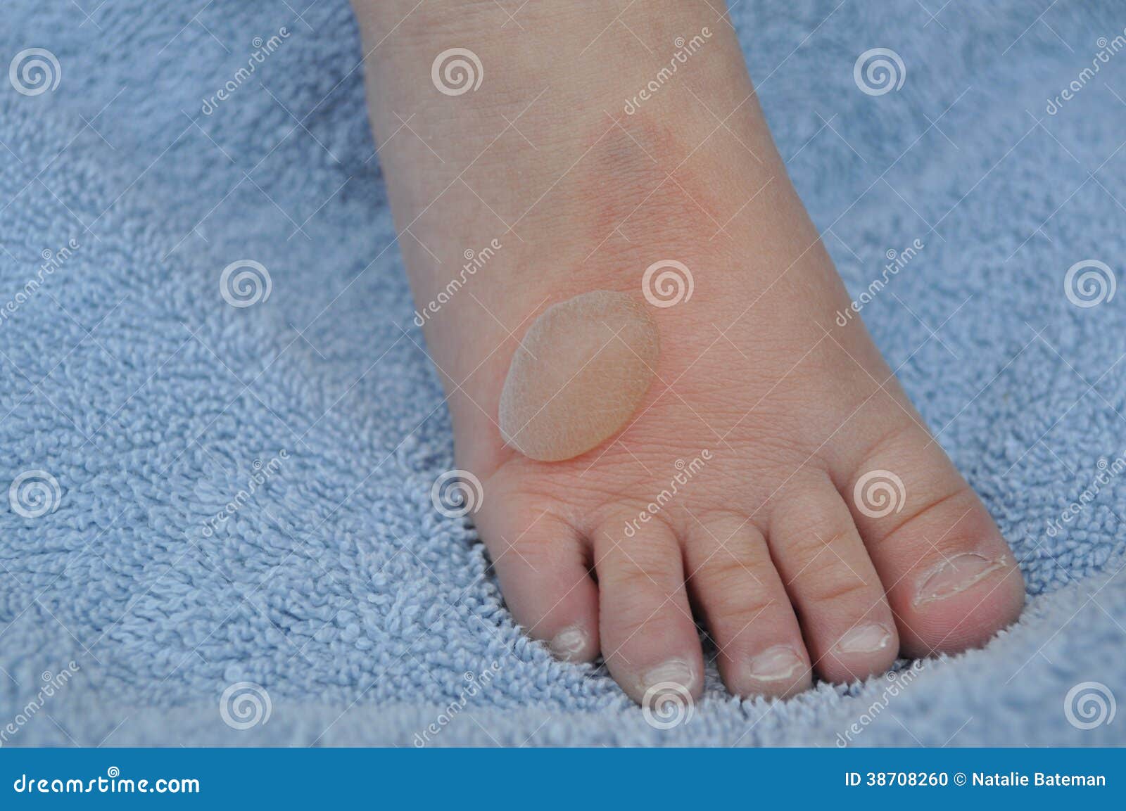 Brandblase stockfoto. Bild von verletzt, verletzung, blase - 38708260