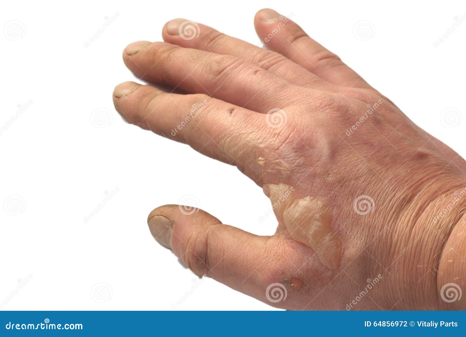 Brandwonden op hand stock foto. Image of ziekte, verdraag - 64856972