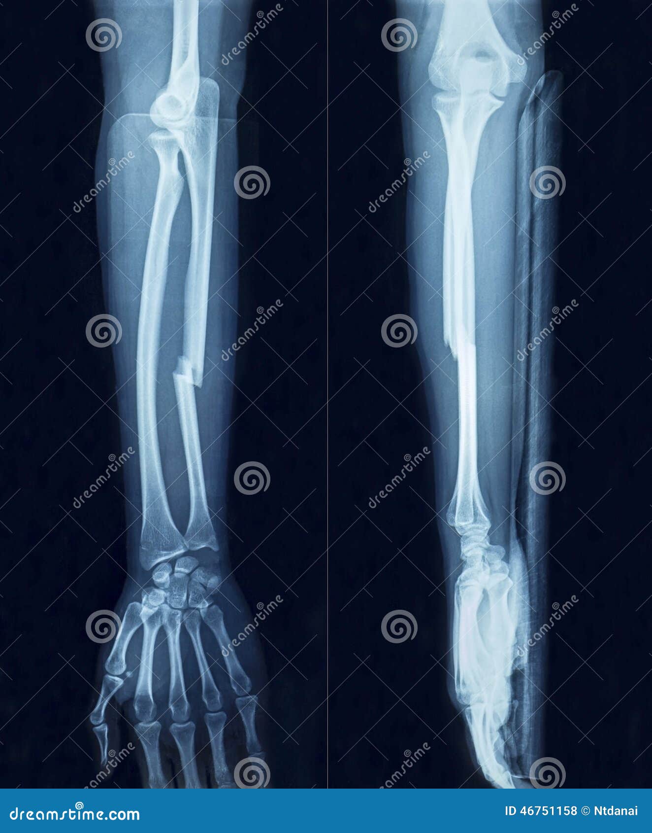 Bras de rayon X de film photo stock. Image du rupture - 46751158