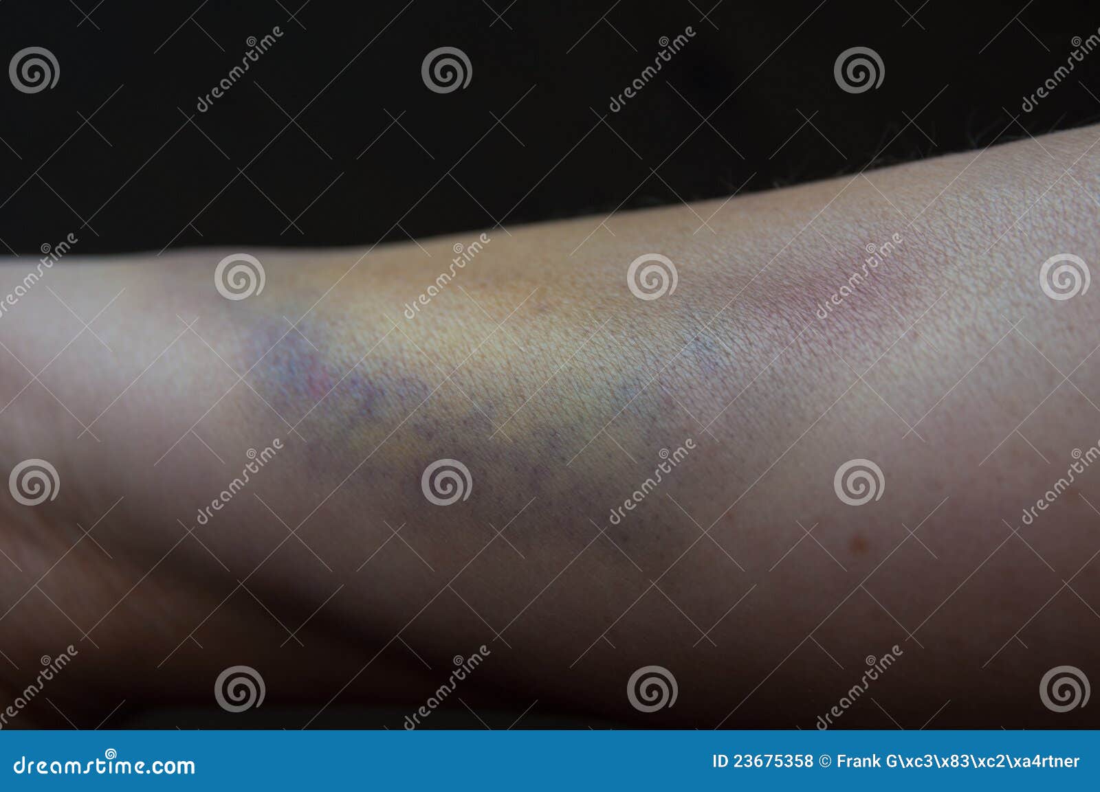 227 Brazo Magullado Fotos - Libres de Derechos y Gratuitas de Dreamstime