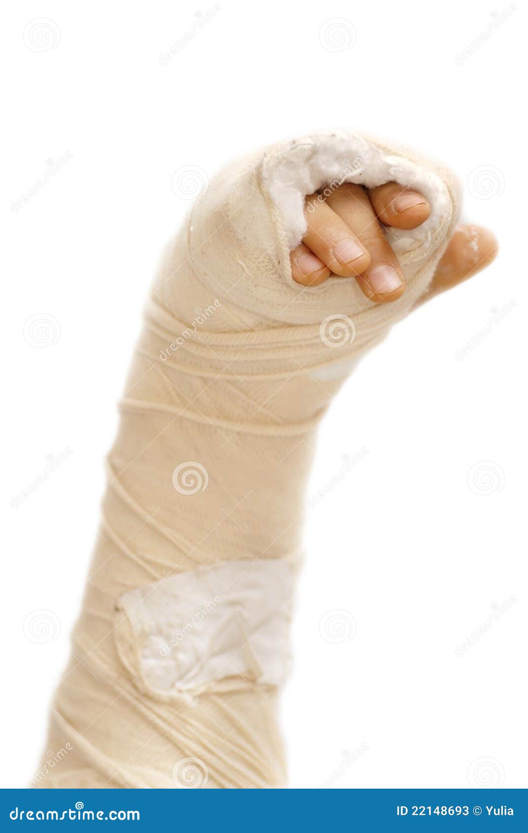 Brazo quebrado imagen de archivo. Imagen de brazo, accidente - 22148693