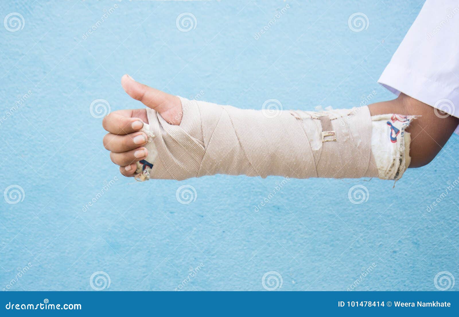 Brazo Quebrado En Fondo Azul Foto de archivo - Imagen de persona ...