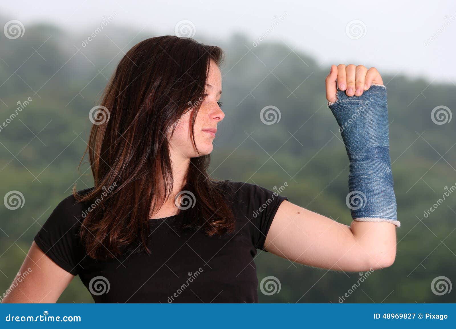 Brazo roto muchacha imagen de archivo. Imagen de muchacha - 48969827