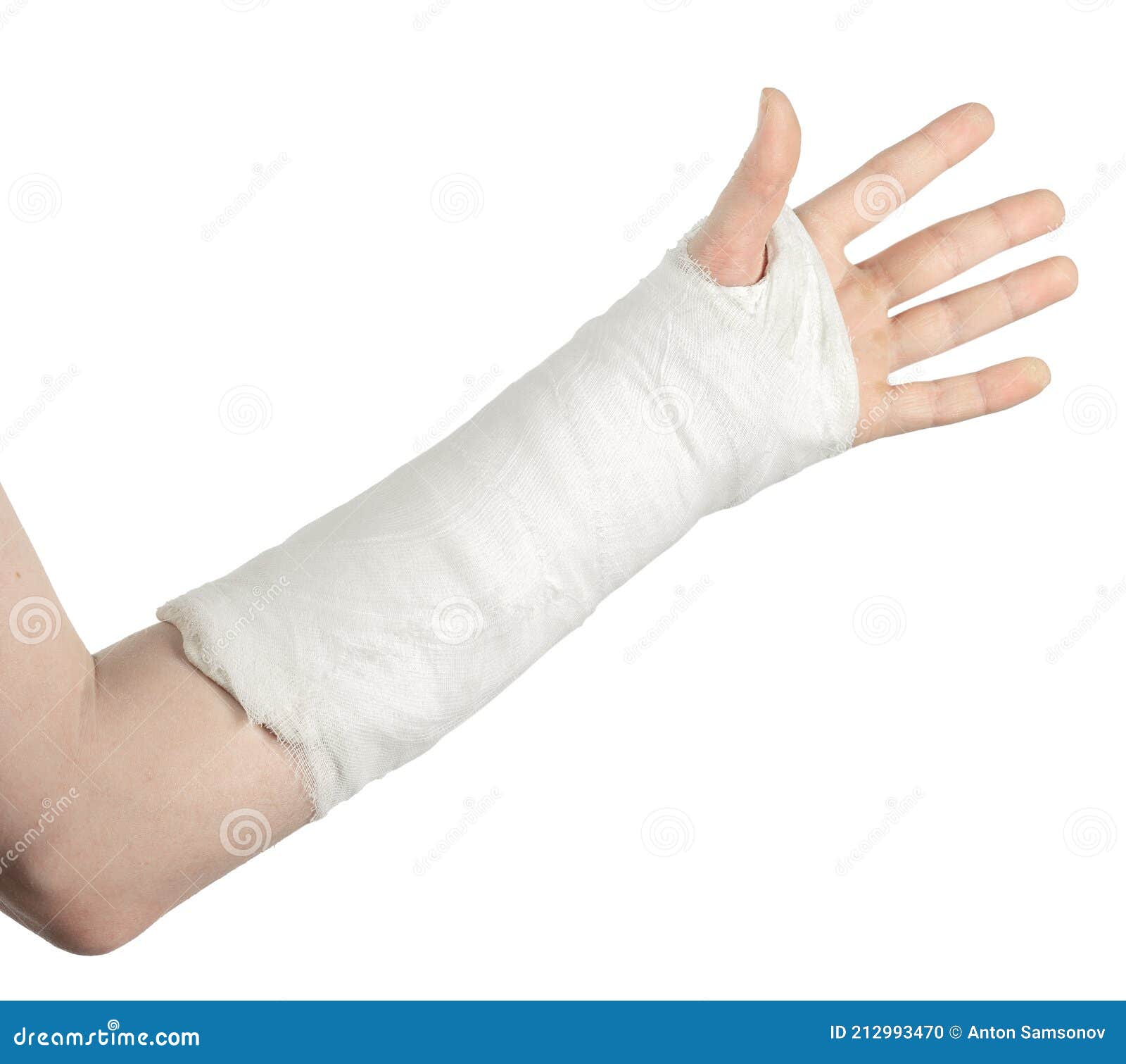 Brazo Roto Sobre Fondo Blanco Foto de archivo - Imagen de huesos, yeso ...