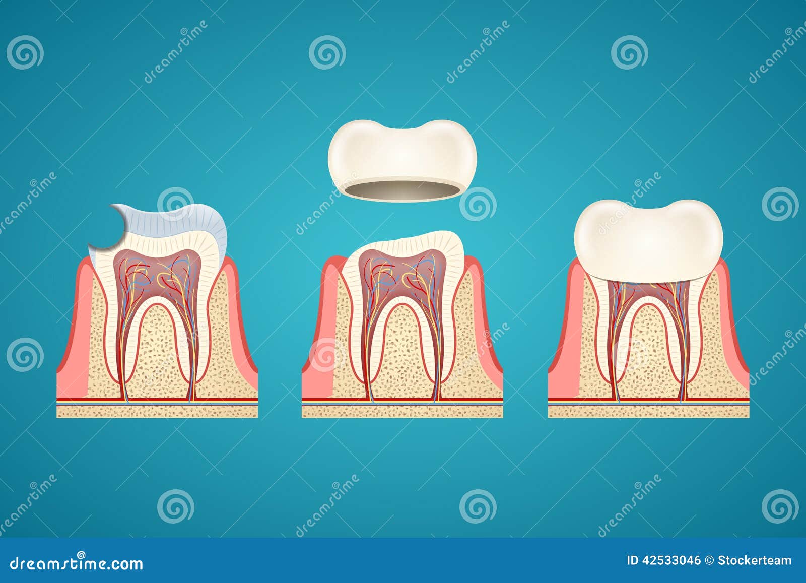 Breaking teeth stock illustration. Illustration of icon - 42533046