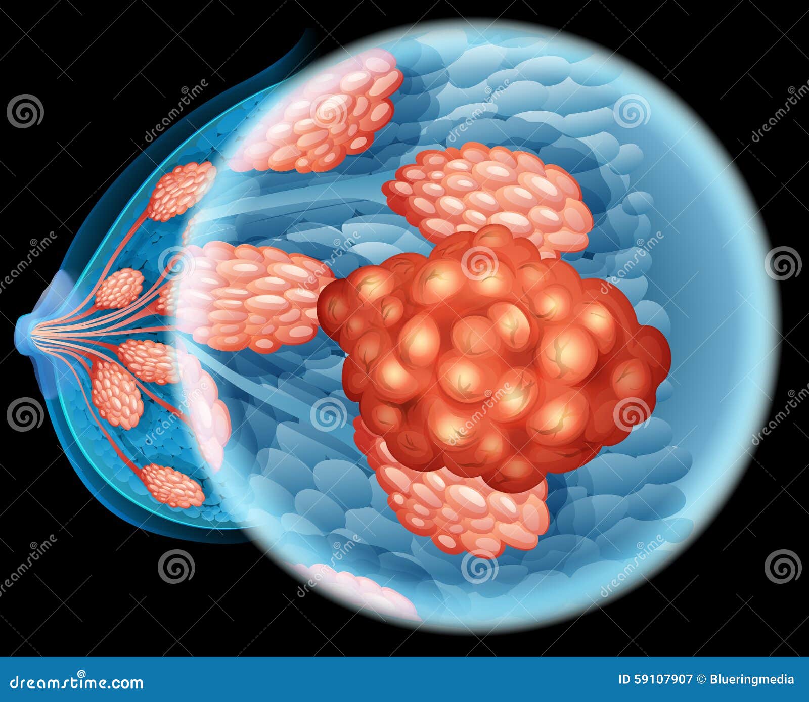 Breast cancer in human stock vector. Illustration of clipart - 59107907