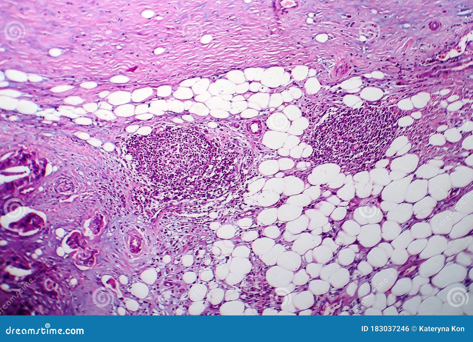Breast Cancer, Light Micrograph Stock Photo - Image of micro ...