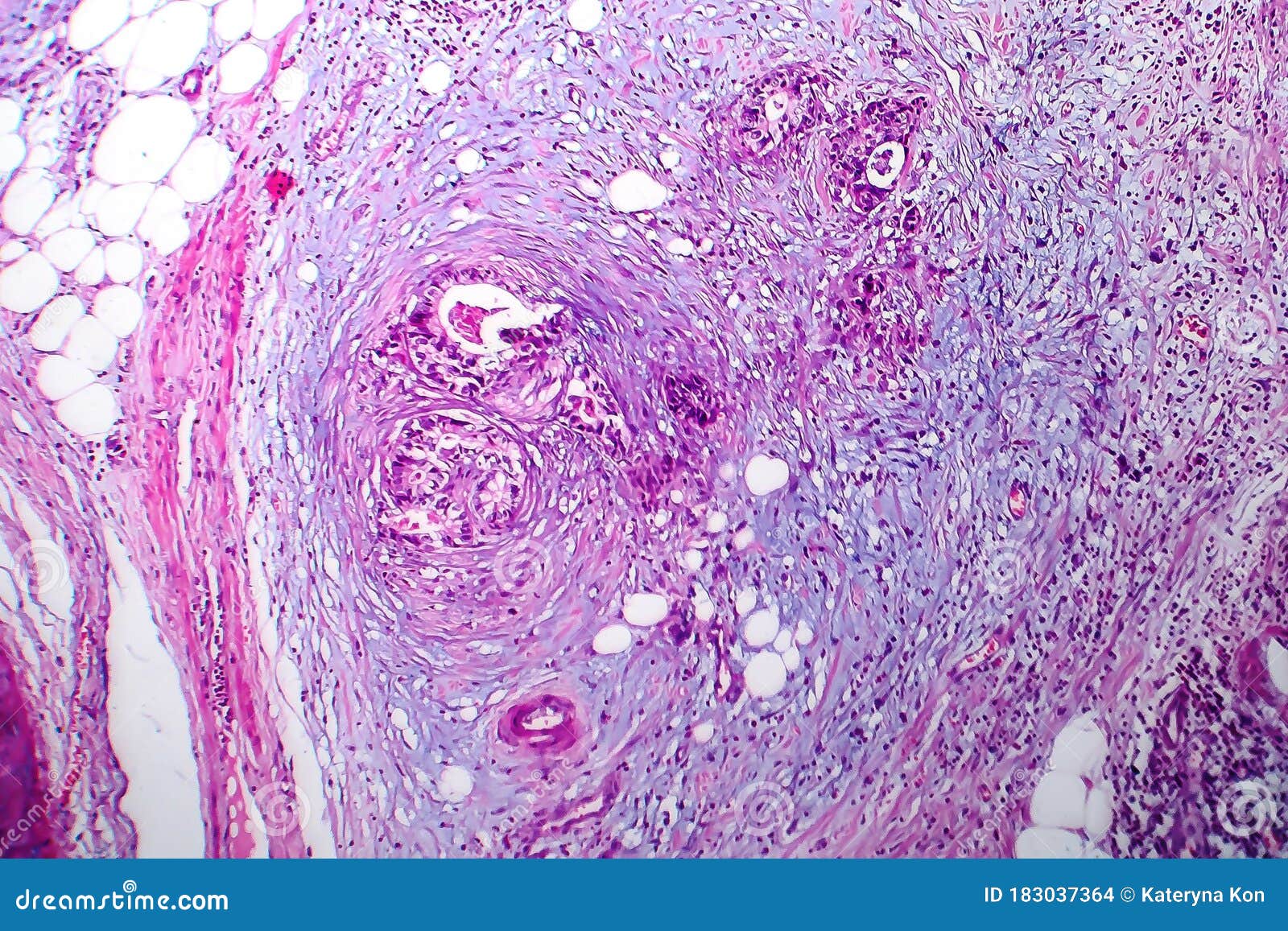 Breast Cancer, Light Micrograph Stock Photo - Image of histology ...