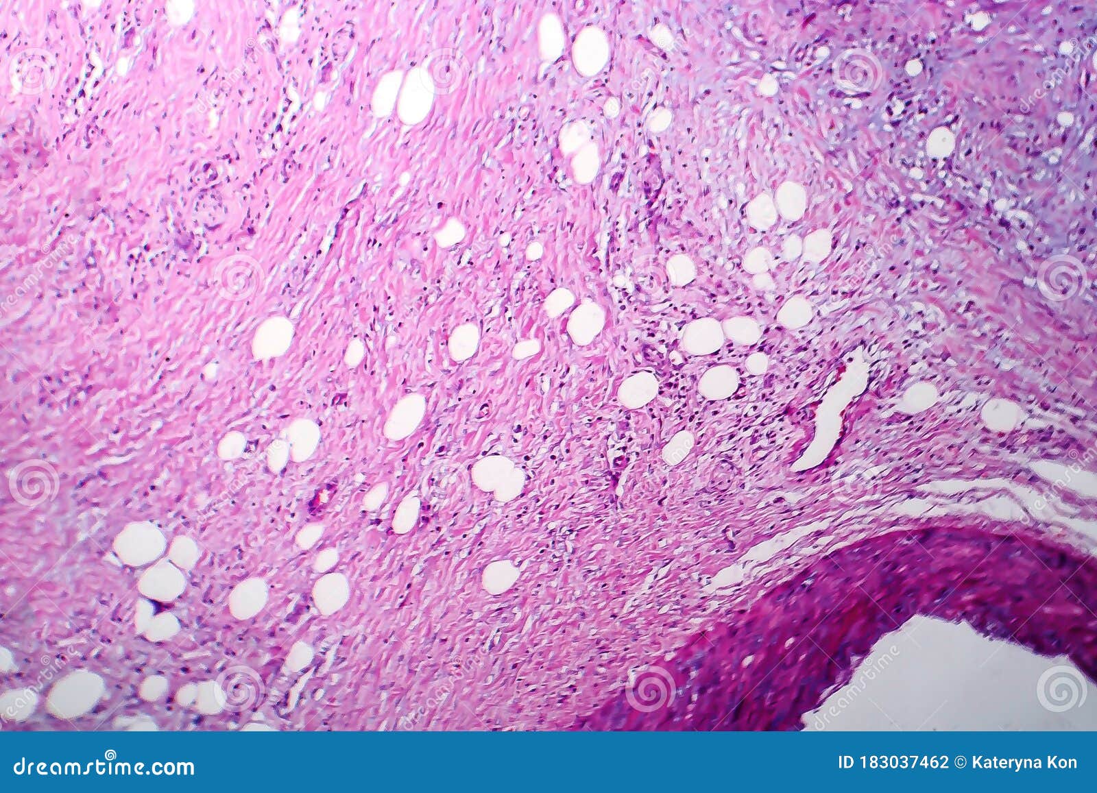Breast Cancer, Light Micrograph Stock Photo - Image of oncology ...