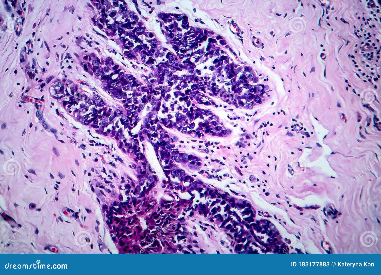 Breast Cancer, Light Micrograph Stock Image - Image of microphotograph ...