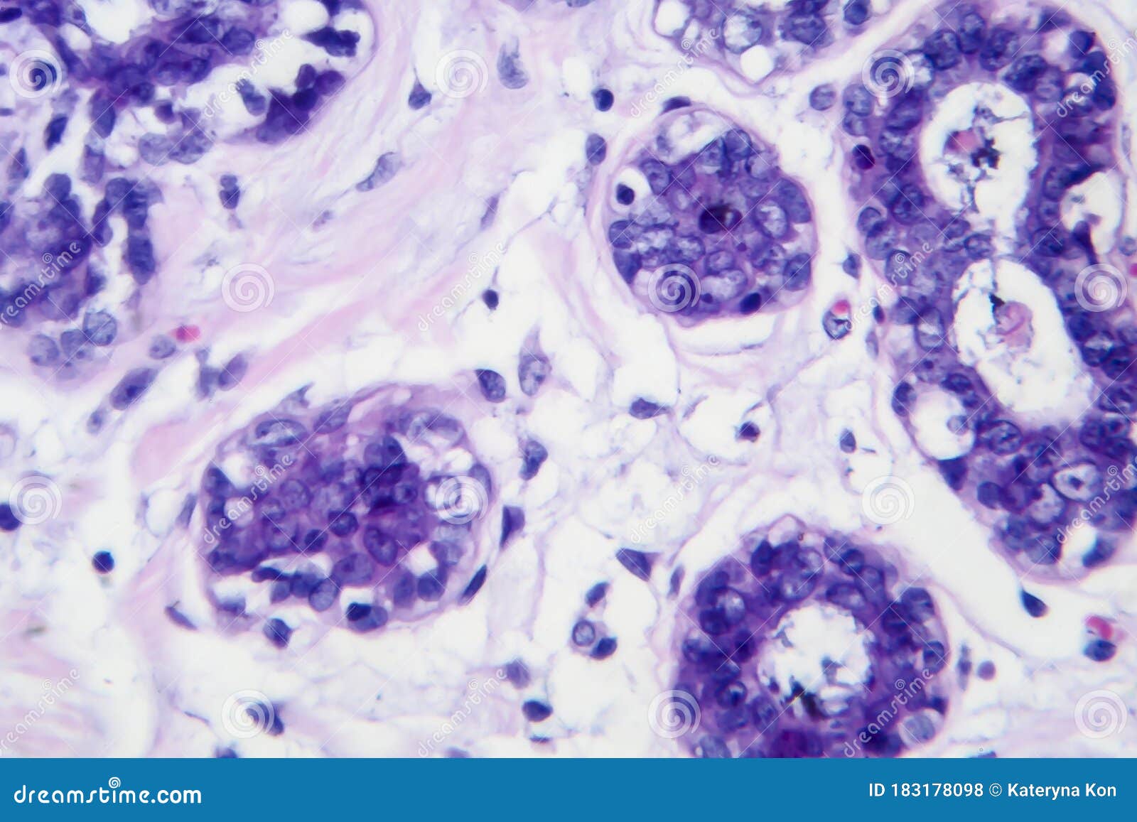 Breast Cancer, Light Micrograph Stock Photo - Image of microscopic ...