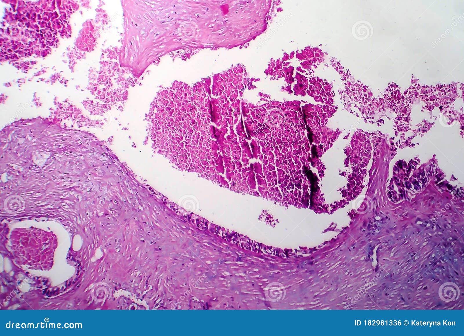 Breast Cancer, Light Micrograph Stock Photo - Image of micrograph ...
