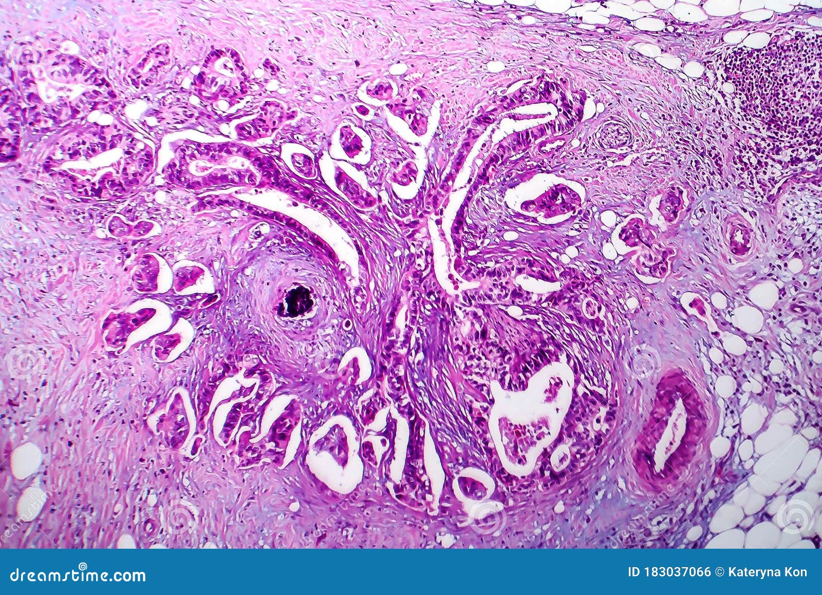 Breast Cancer, Light Micrograph Stock Photo - Image of carcinoma ...
