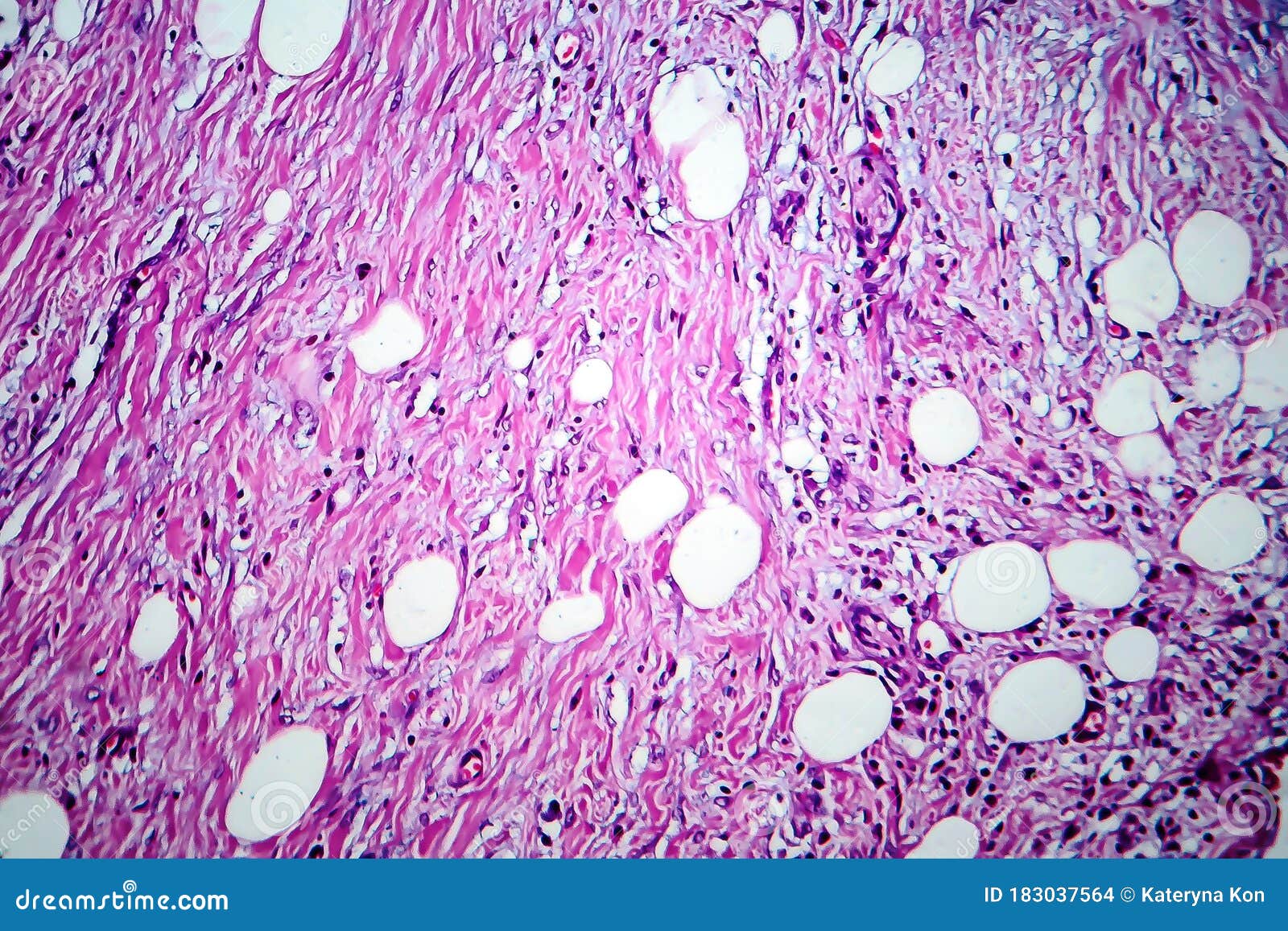 Breast Cancer, Light Micrograph Stock Photo - Image of micrograph ...