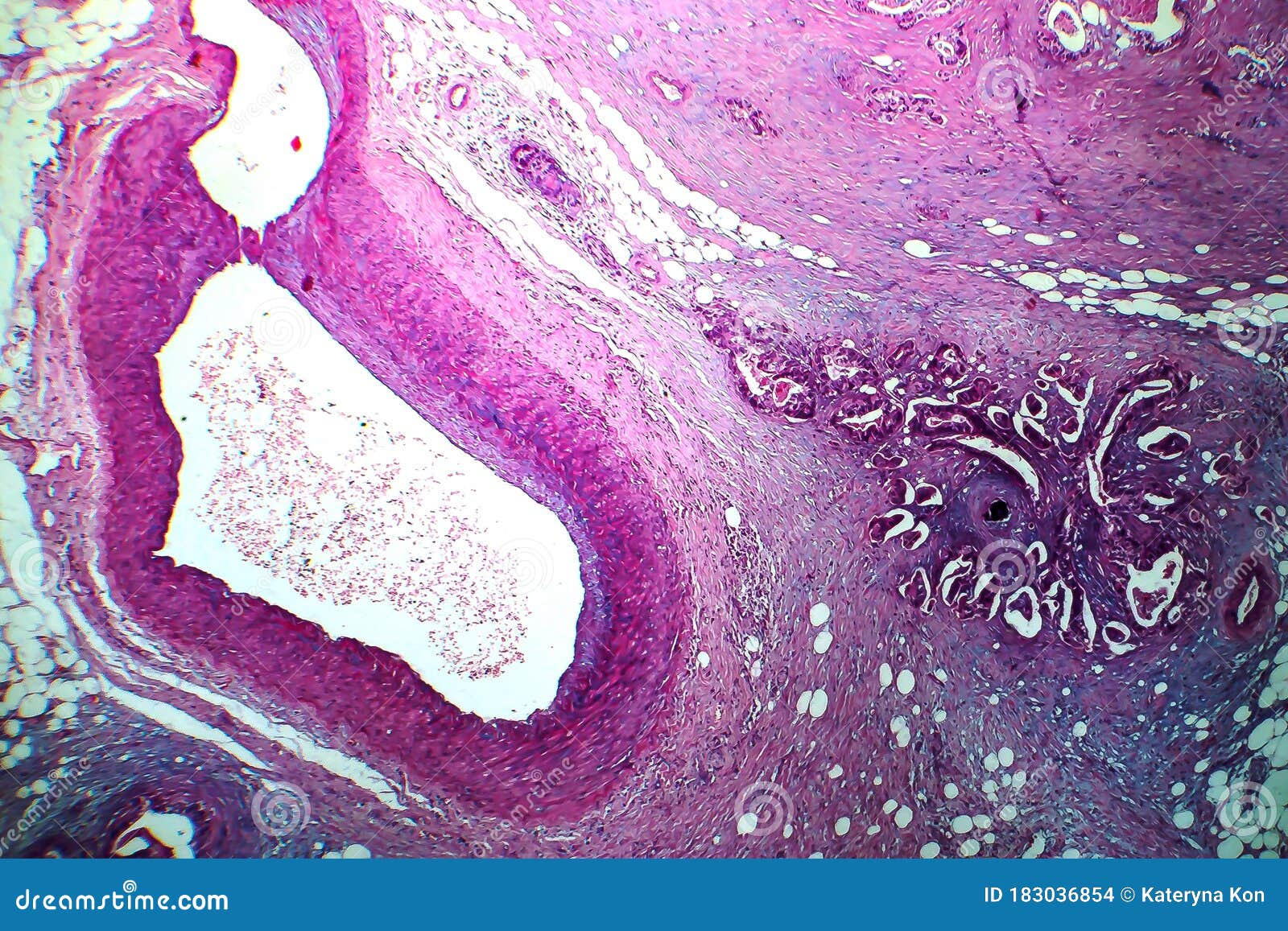 Breast Cancer, Light Micrograph Stock Photo - Image of morphology ...