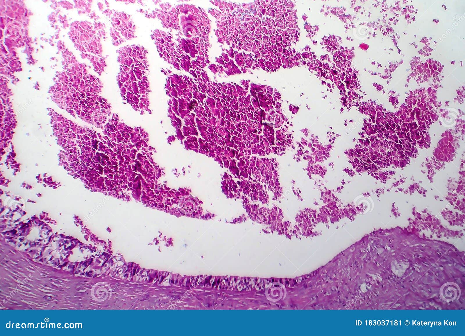 Breast Cancer, Light Micrograph Stock Image - Image of pathology, high ...