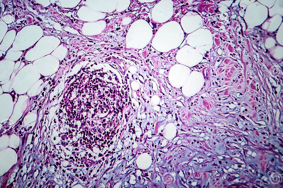 Breast Cancer, Light Micrograph Stock Photo - Image of high, female ...