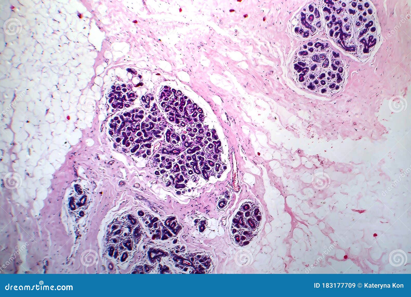 Breast Cancer, Light Micrograph Stock Image - Image of women, pathology ...