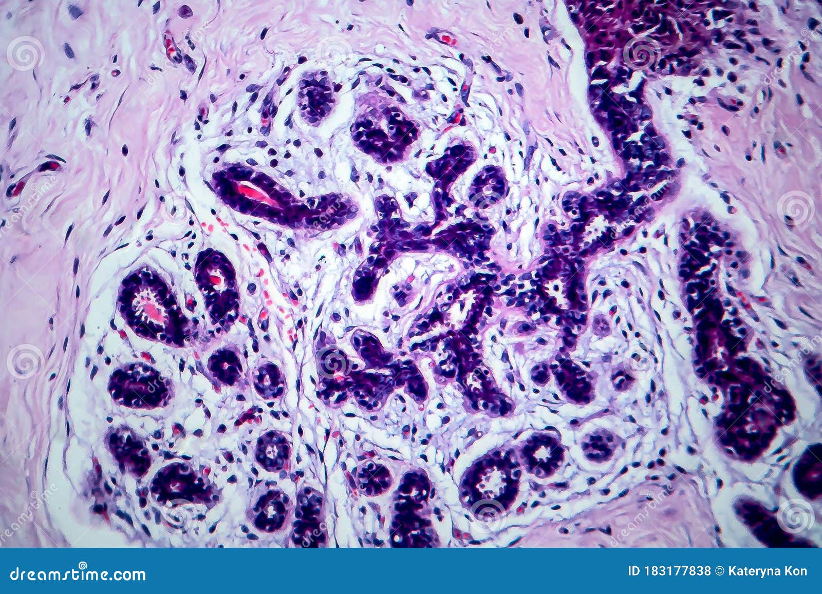 Breast Cancer, Light Micrograph Stock Photo - Image of morphology ...