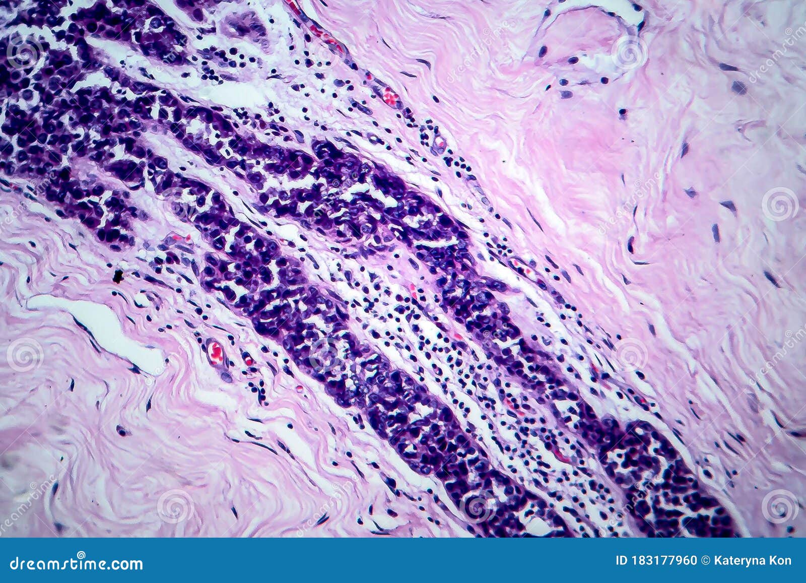 Breast Cancer, Light Micrograph Stock Photo - Image of cancer ...