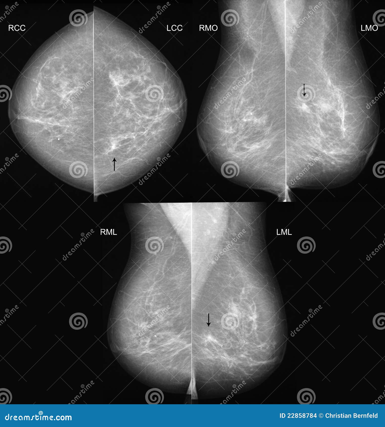Breast Cancer Mammography in 3 Projections Stock Photo - Image of body ...