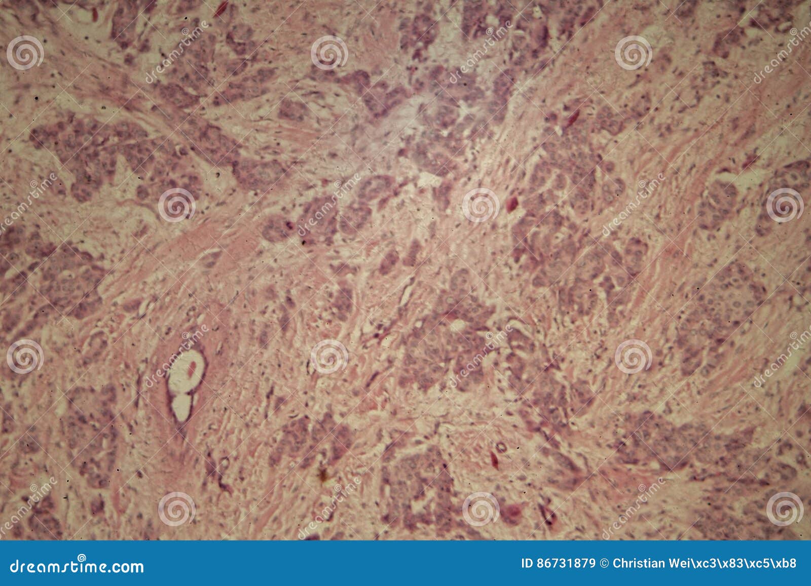 Breast Cancer Under the Microscope Stock Image - Image of microscopic ...
