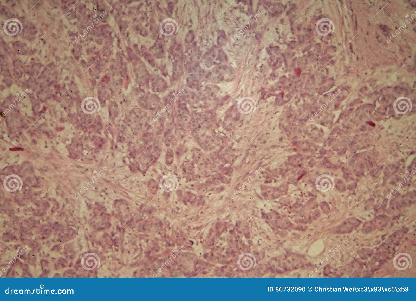 Breast Cancer Under the Microscope Stock Photo - Image of pathology ...