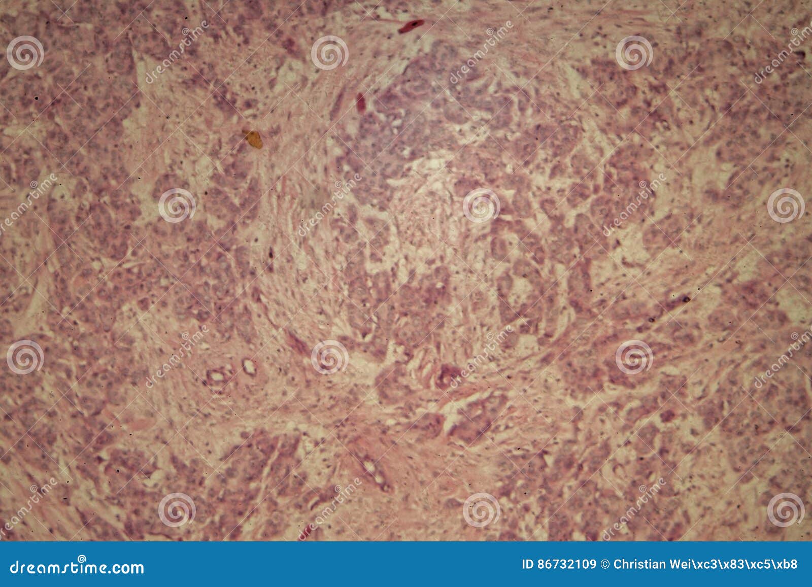 Breast Cancer Under the Microscope Stock Image - Image of neoplasm ...